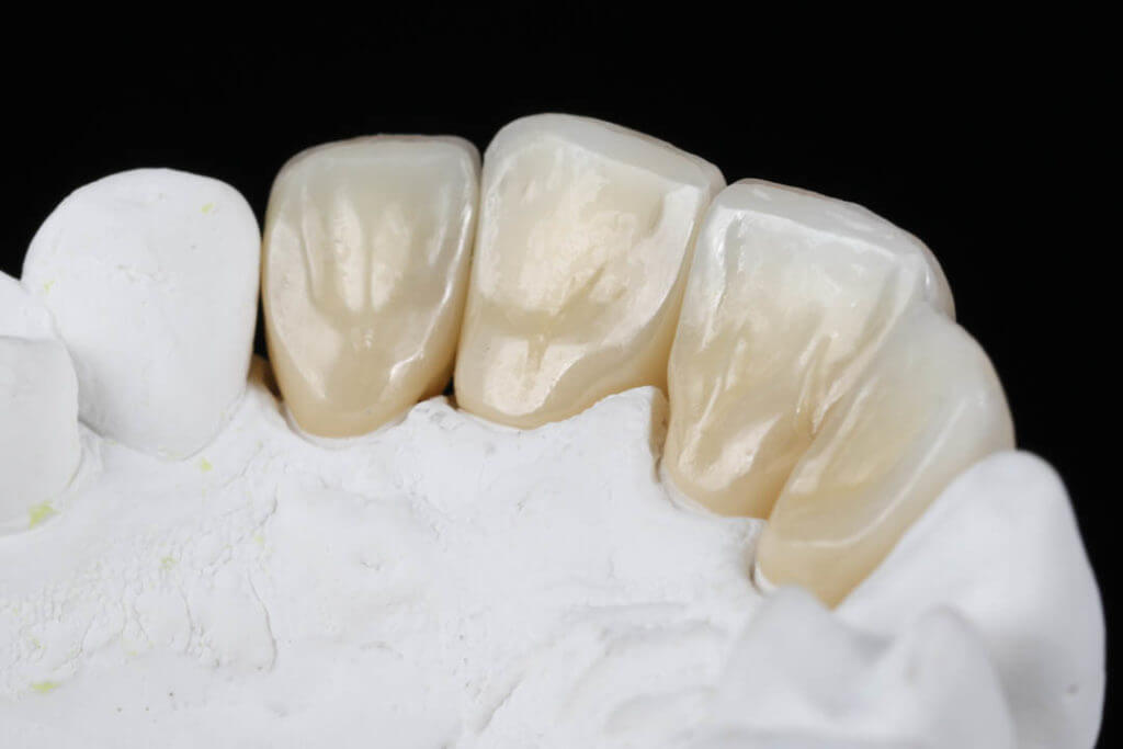 Werkstoffkunde: Zirkonoxid und seine Transluzenz?